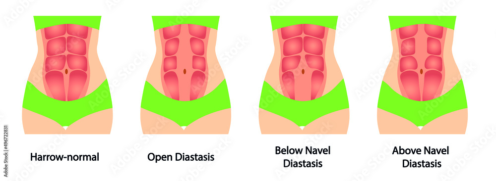 Diastasis illustration. Different types of diastasis. Abdomen wall ...