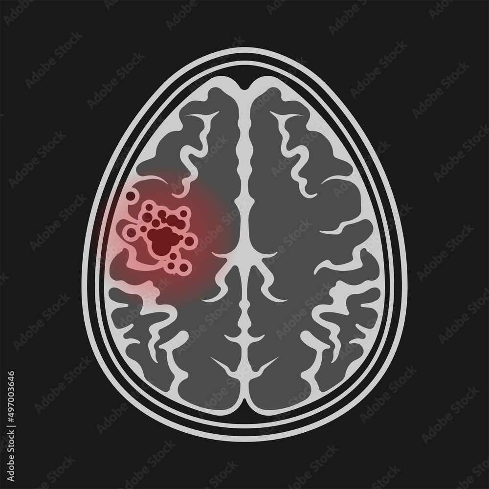 ct scan X-ray image mri diagnose capillaries system stroke scalp brain ...