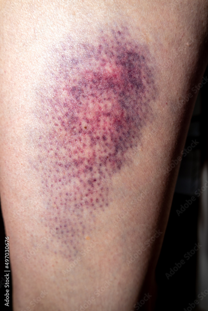 Terrible bruise on the upper leg of a woman Stock Photo | Adobe Stock
