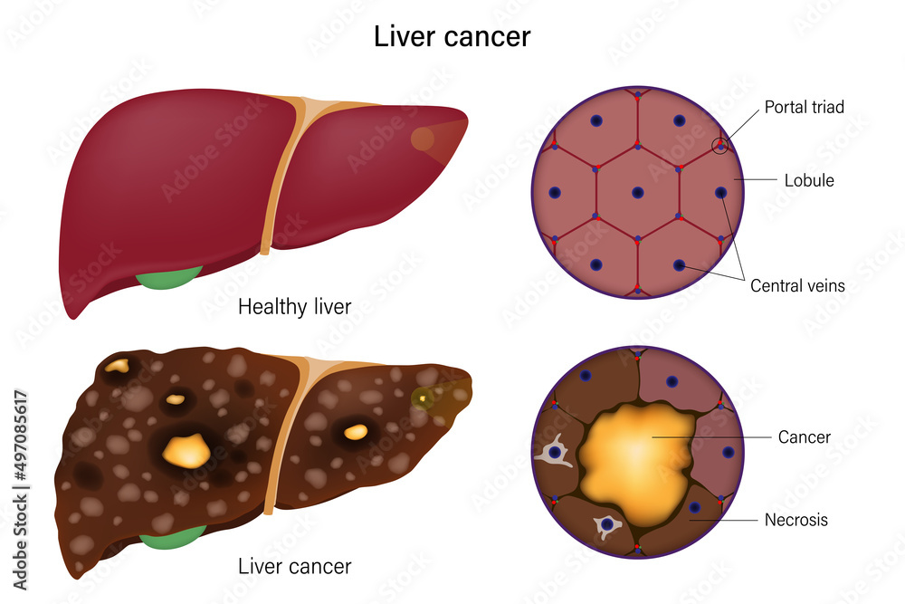 Liver histology. Normal liver and liver cancer. Liver disease for ...