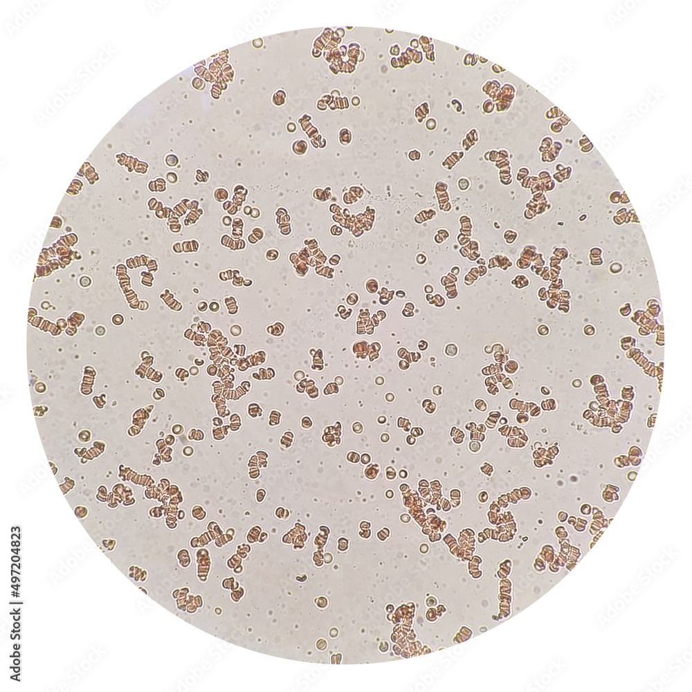 The stacks of red blood cells or Rouleaux formation in light microscope ...