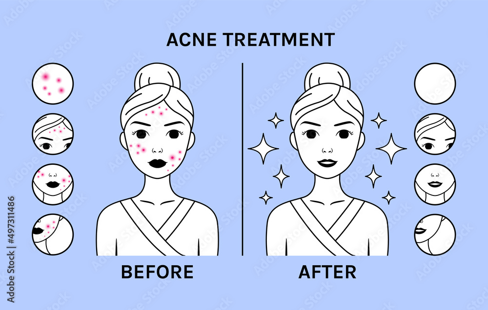 Woman with Pimples on Beautiful Face. Acne Treatment. Skin Problems ...