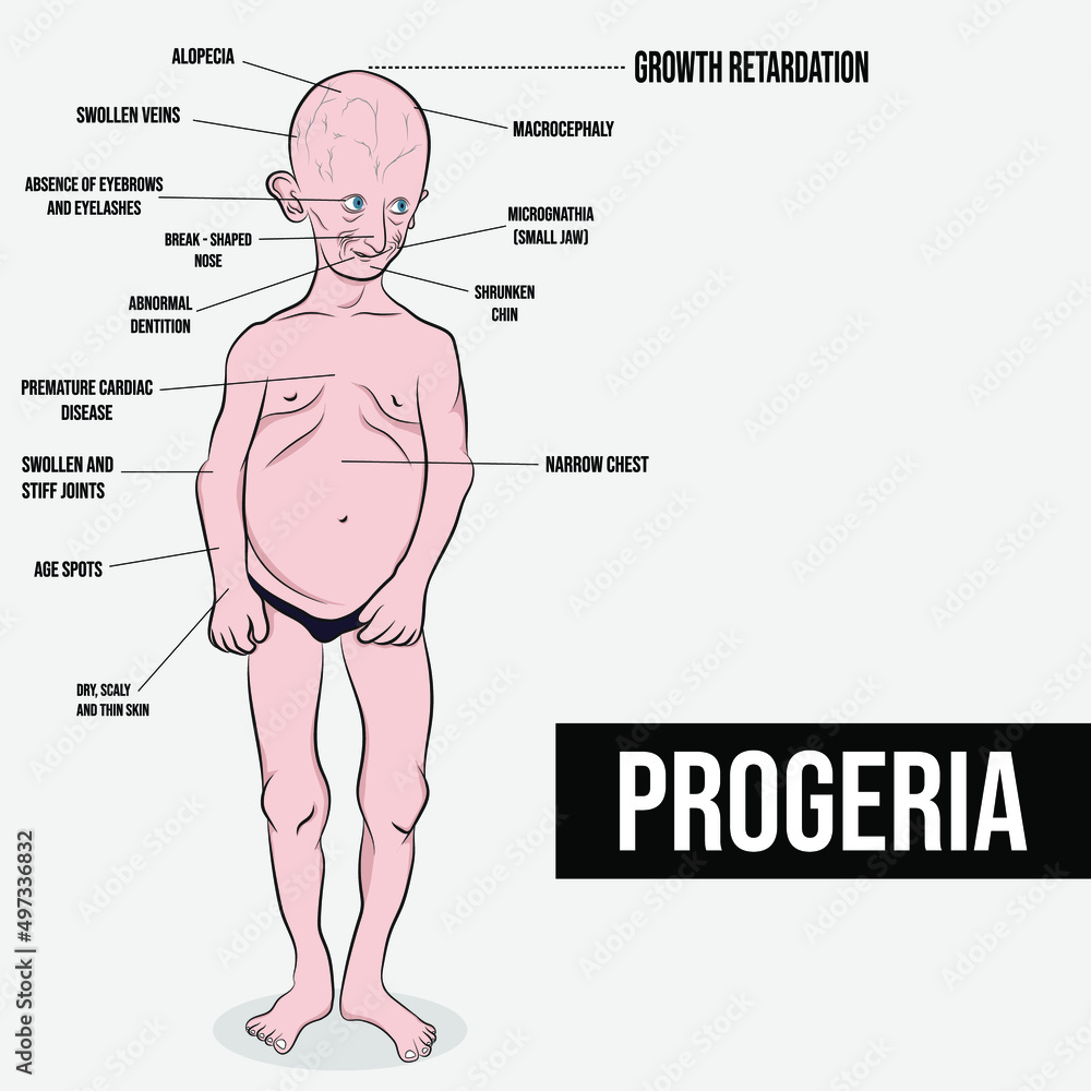 Poster Progeria syndrome, a progressive genetic disorder that causes premature aging in children ...