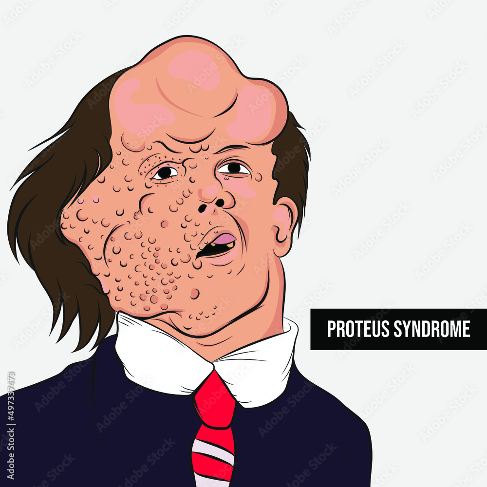 Proteus Syndrome is a congenital disease that causes excessive skin ...