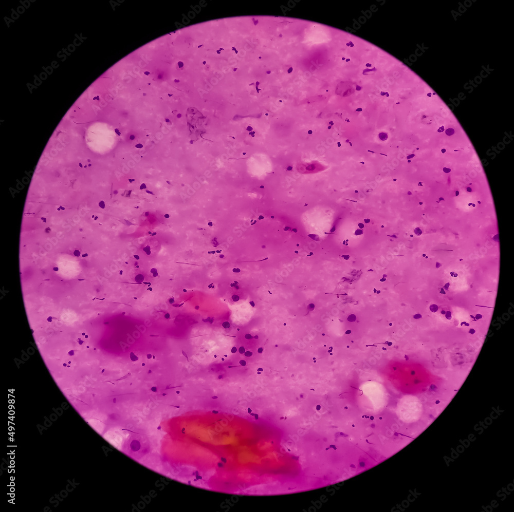 Thyroglossal cyst(FNAC): Microscopic show anucleated squames and ...