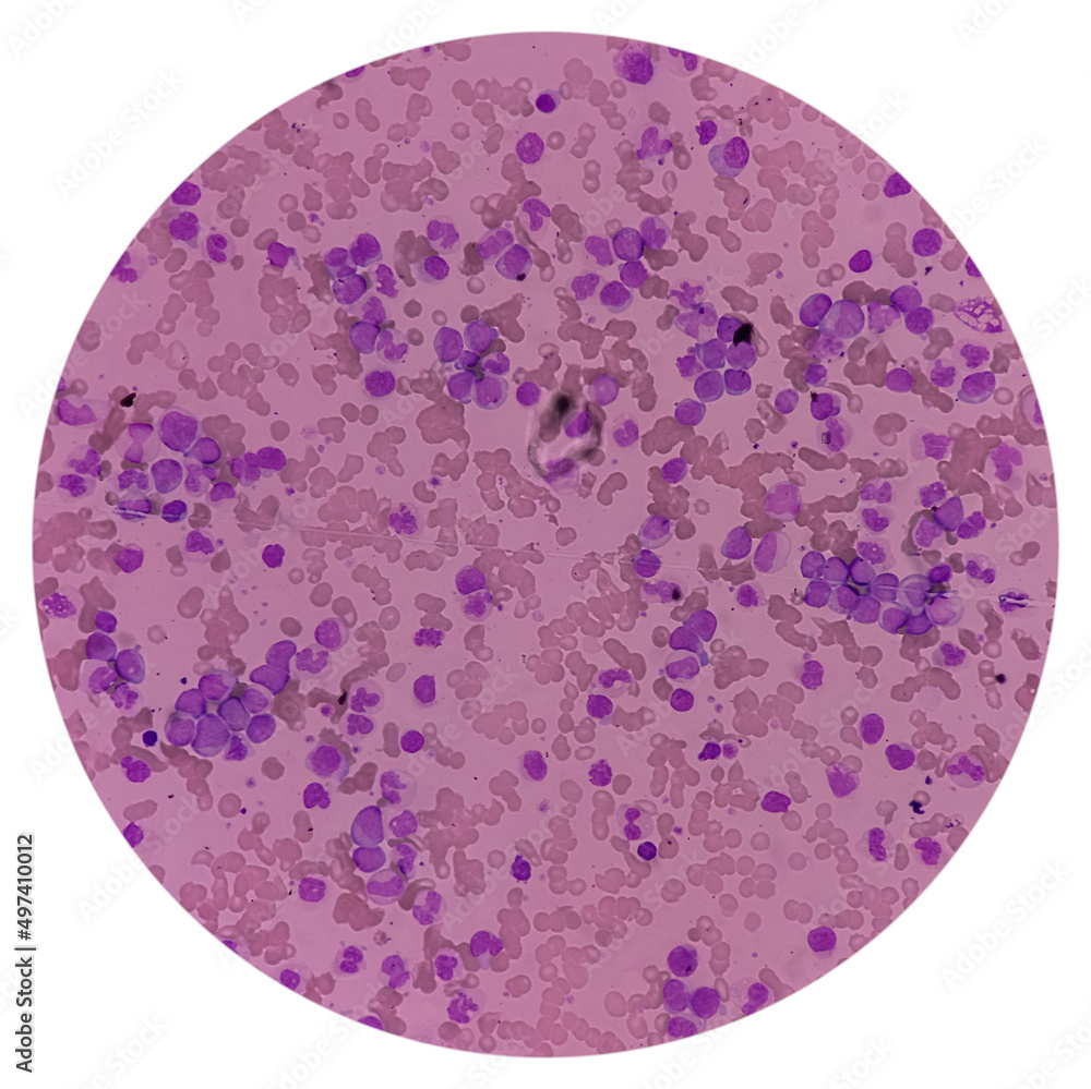 Chronic myeloid leukemia(CML) is a type of blood cancer. show the ...