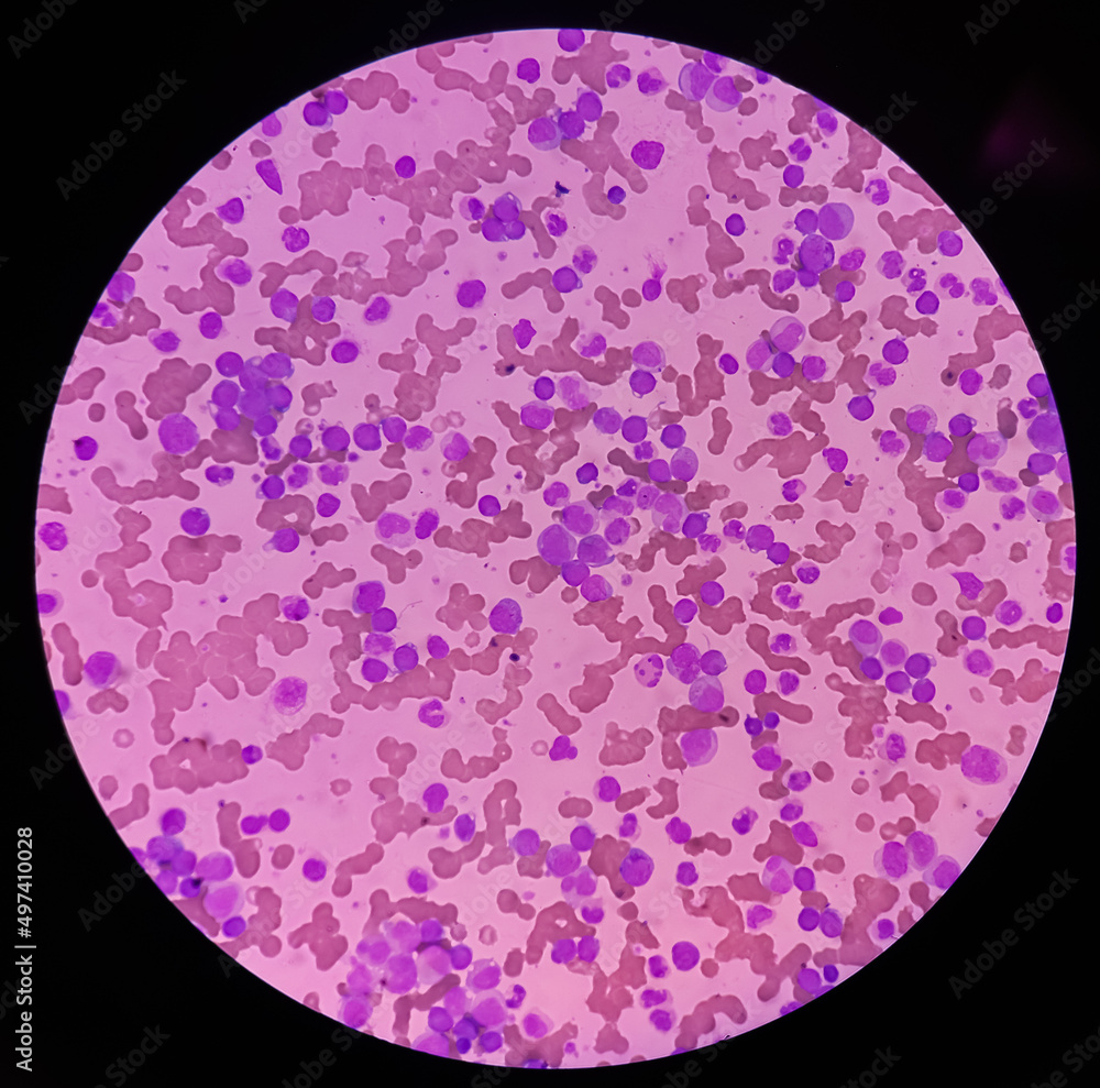 Chronic myeloid leukemia(CML) is a type of blood cancer. show the ...