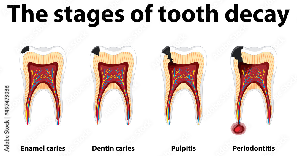 Infographic of human in the stages of tooth decay vector de Stock ...