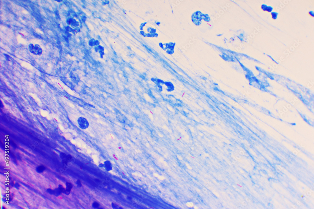 Mycobacterium tuberculosis positive (small red rod) in sputum smear ...
