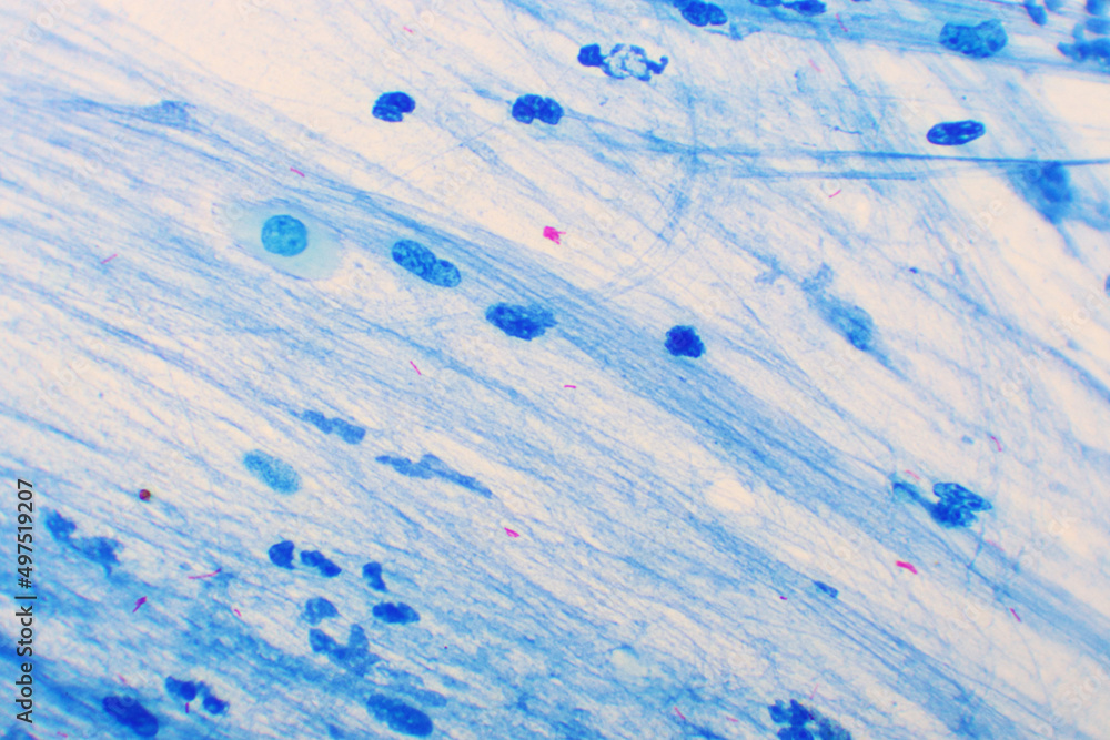 Mycobacterium tuberculosis positive (small red rod) in sputum smear ...