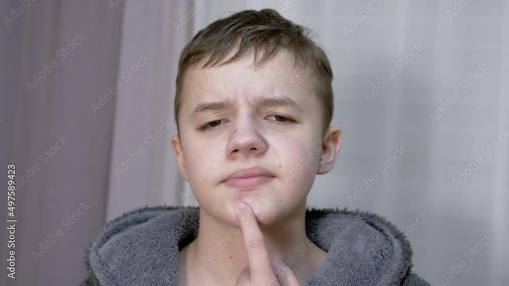 Frustrated Teenager Touches, Pressing Pimples on his Face with finger ...
