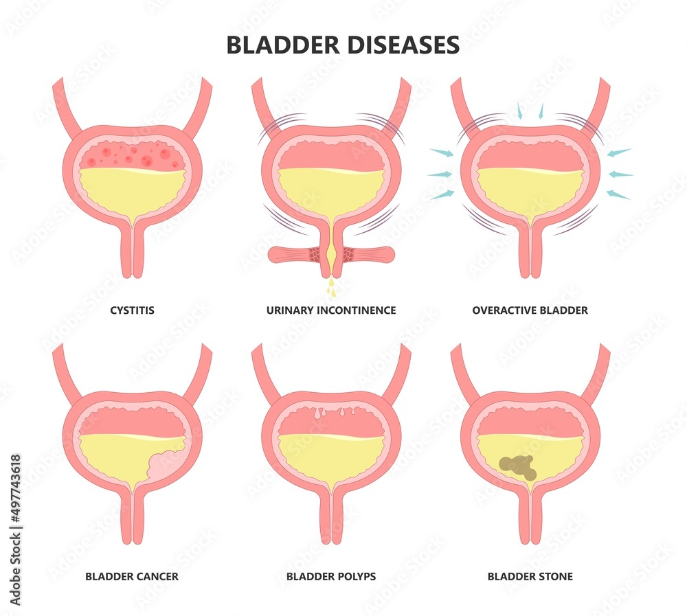 Vetor de urination older nerve brain spasm urge pass urine of pelvic ...