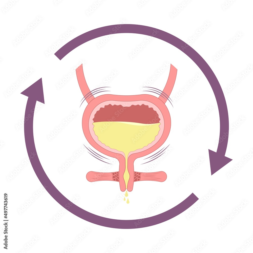 Cystitis anuria tumor cancer toilet frequently urination urge pass ...