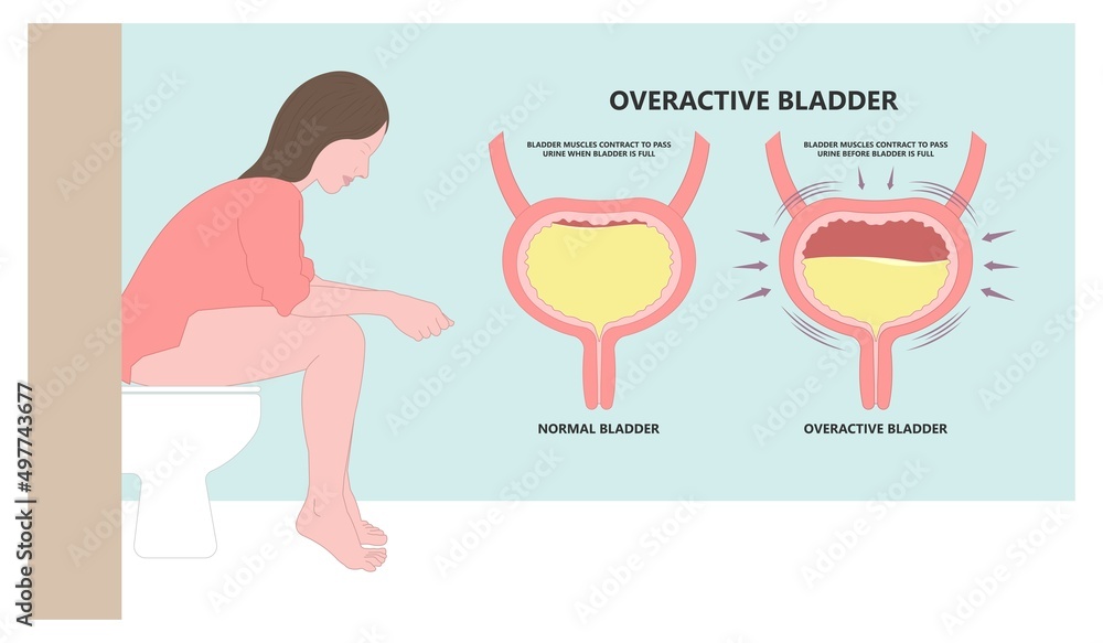 Vetor de urge pass urine of pelvic floor muscle frequently Bed wetting ...