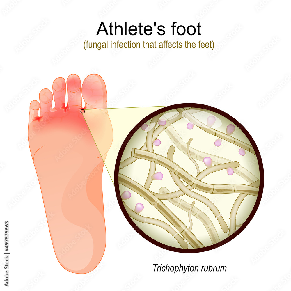 Athletes foot. Close-up of Trichophyton rubrum Stock Vector | Adobe Stock