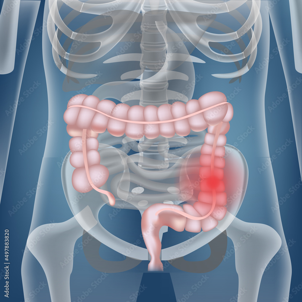 Bowel cancer. The location of the internal organs against the ...