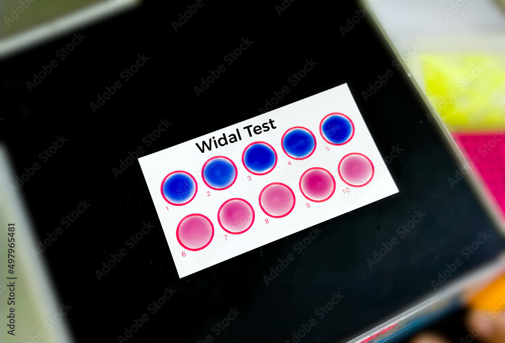 Widal test by agglutination method at plate isolated on black ...