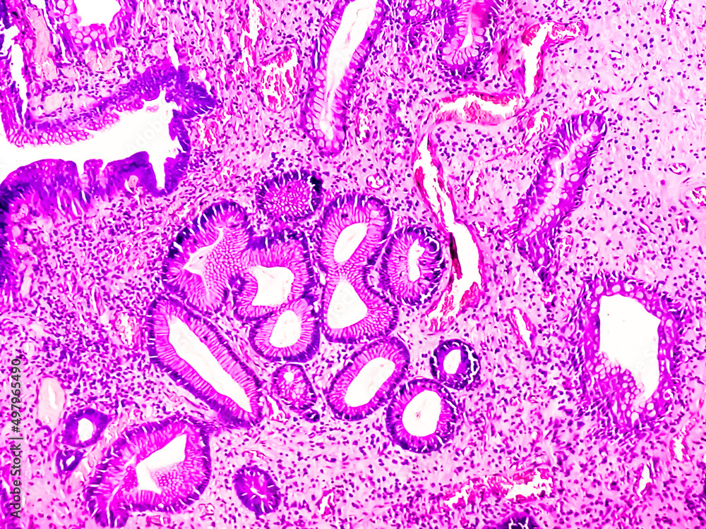Microscopic view of stomach tissue biopsy showing Adenomatous polyps ...