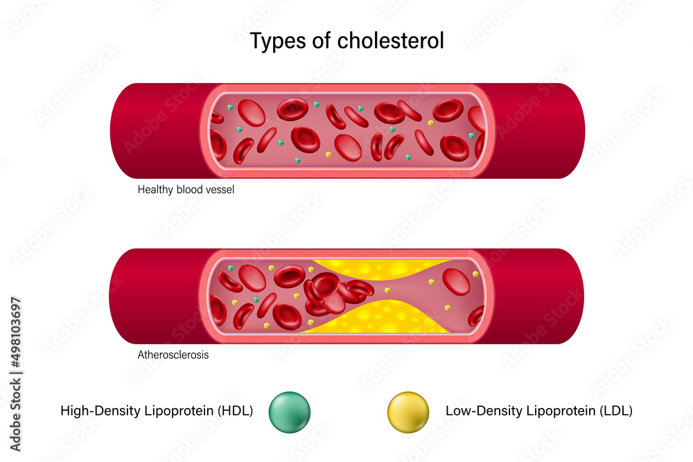 Types of cholesterol. High-Density Lipoprotein (HDL) and Low-Density ... Types of cholesterol. High-Density Lipoprotein (HDL) and Low-Density ...