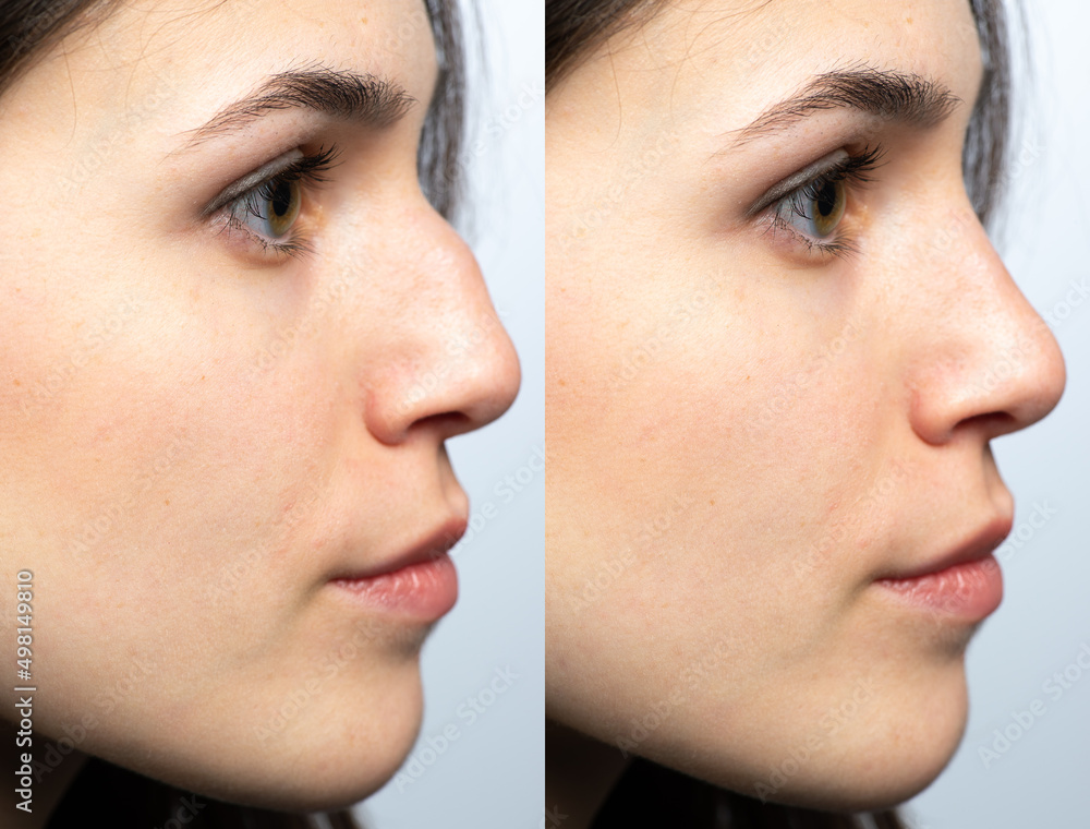 Nose before and after nasal filler surgery Stock Photo | Adobe Stock