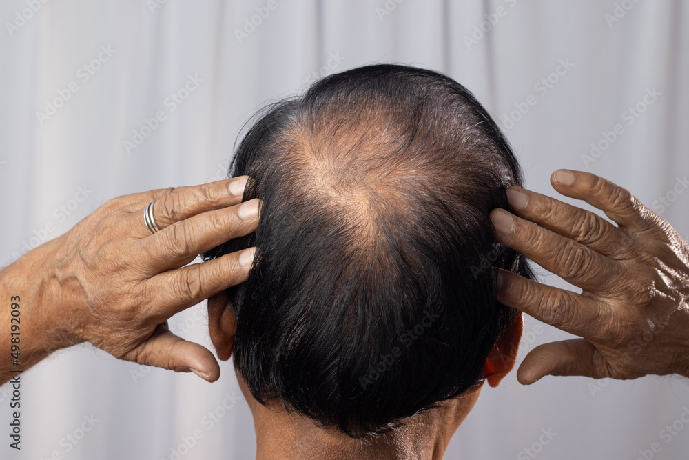 hair fall problem for men Stock Photo | Adobe Stock
