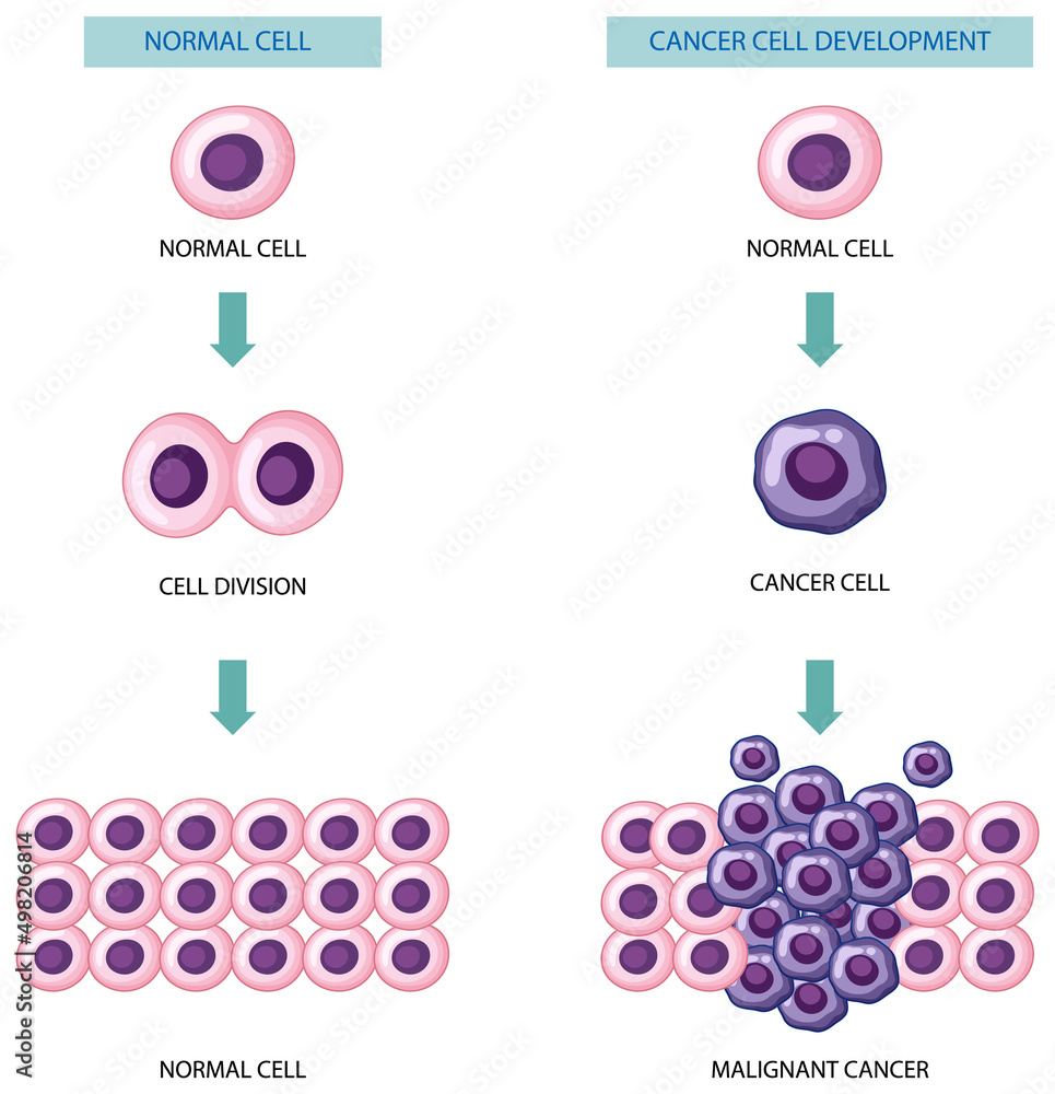 Process of cancer cell development Stock Vector | Adobe Stock