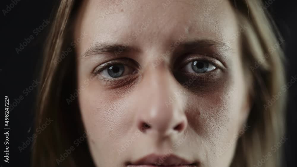 A sad beaten up woman with wounds on face is looking at camera. Female ...