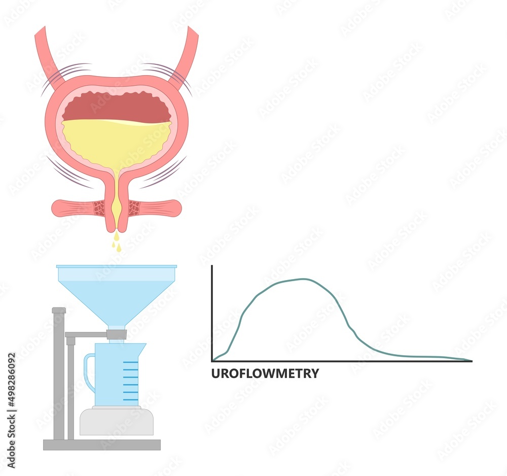 urination study test urine leak EMG Urethral flow often tract exam ...