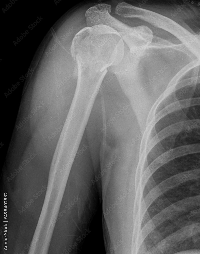 x-ray image of proximal humerus fracture Stock Photo | Adobe Stock