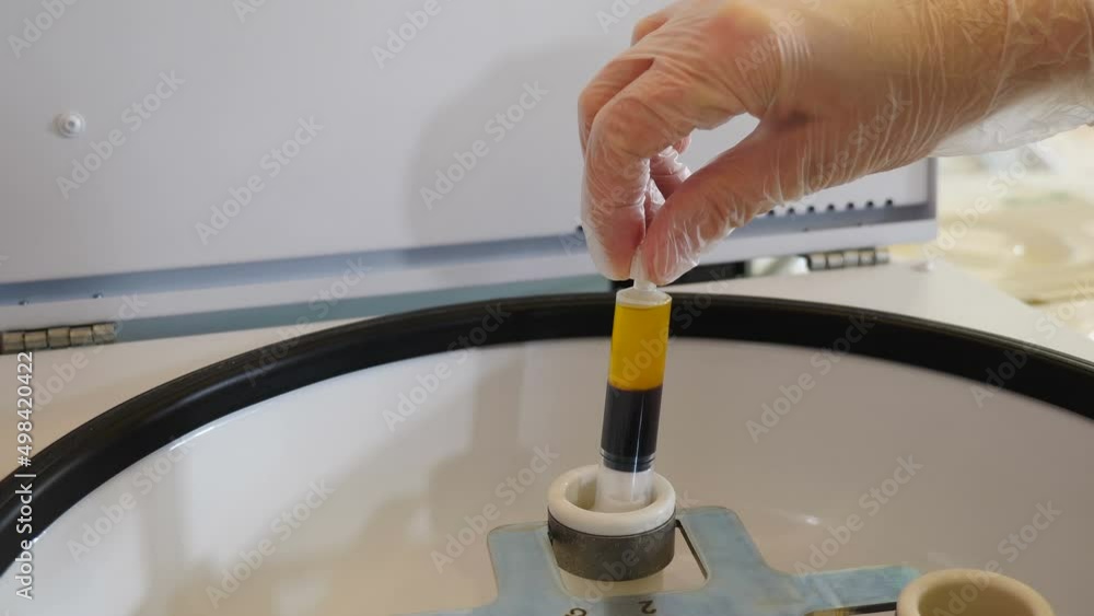 Medical syringe with blood and separated plasma. Cosmetologist prepares ...