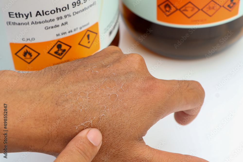 Skin abrasions caused by corrosive chemical , chemistry in the ...