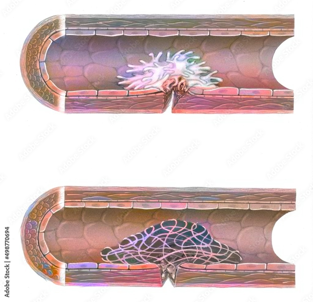Platelet aggregation involved in the coagulation process. ilustração do ...