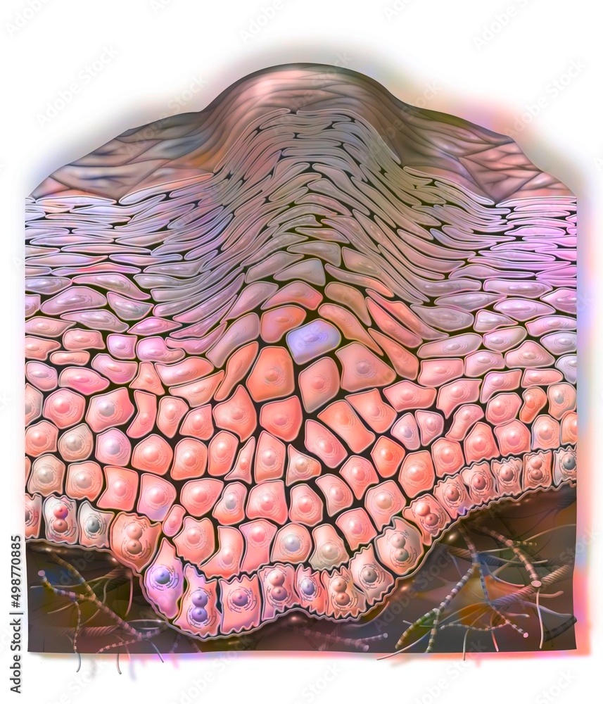 Common wart: benign skin epithelial tumor caused by papillomaviruses ...