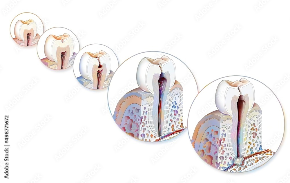 Tooth: formation and development of dental caries. Stock Illustration ...