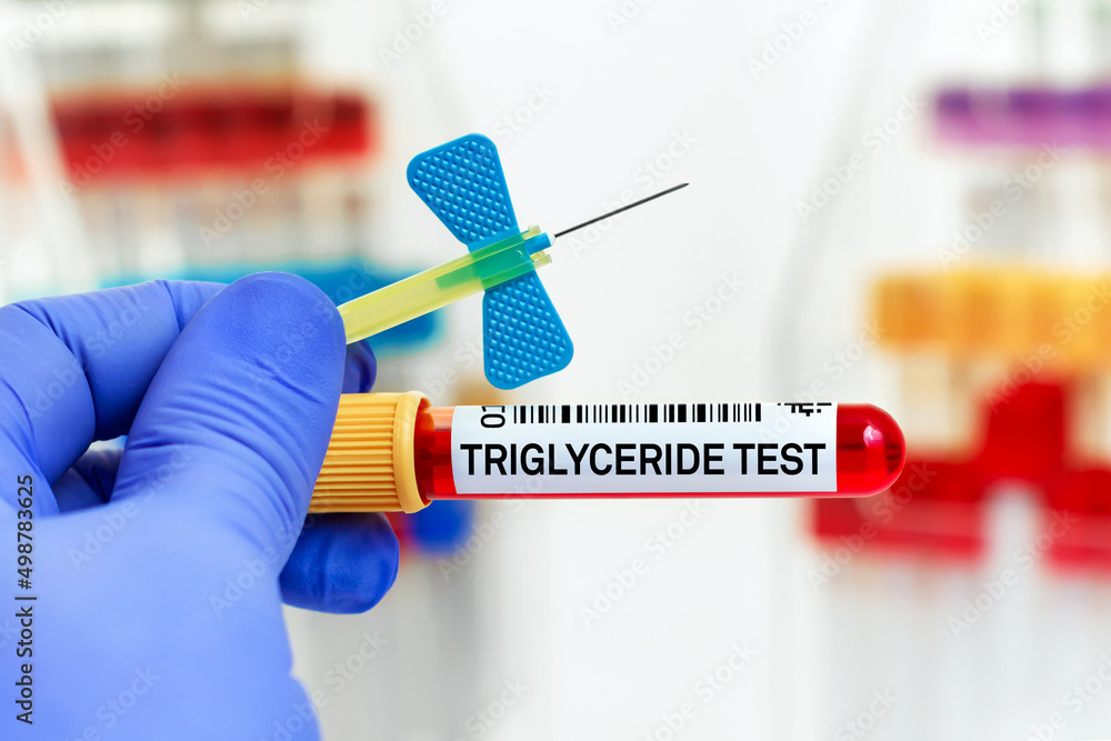 Doctor holding Blood tube for Triglycerides analysis. Blood sample of ...