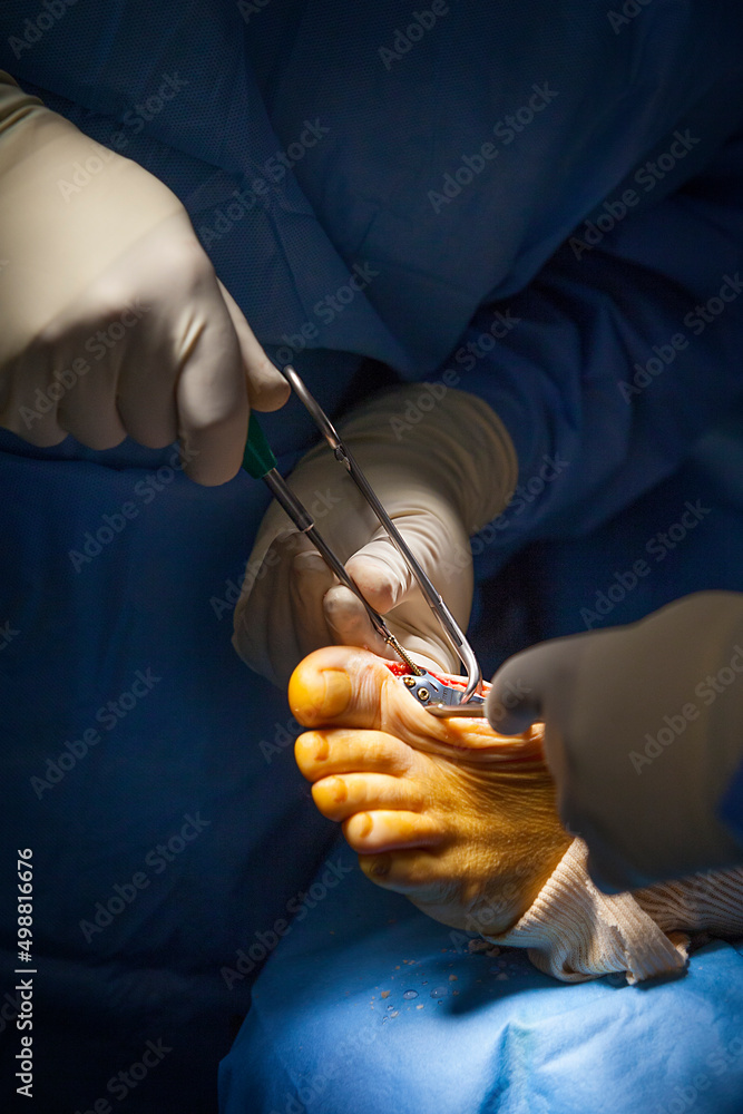 Orthopedic surgery operating room for arthrodesis of the big toe. Stock ...