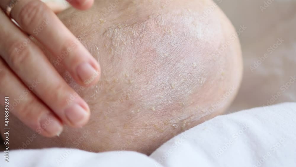 applying cream moisturizer on seborrheic dermatitis newborn baby's head ...