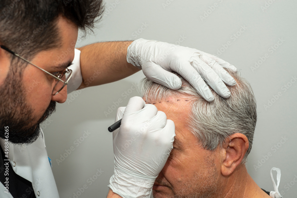 Marking hair line Point of receding hair line for hair transplant ...