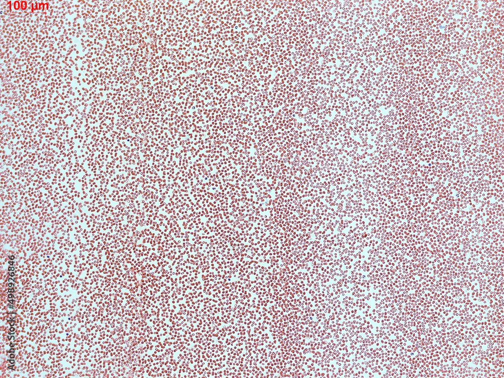 Human blood cell under microscope. Magnified smear of red blood cells ...
