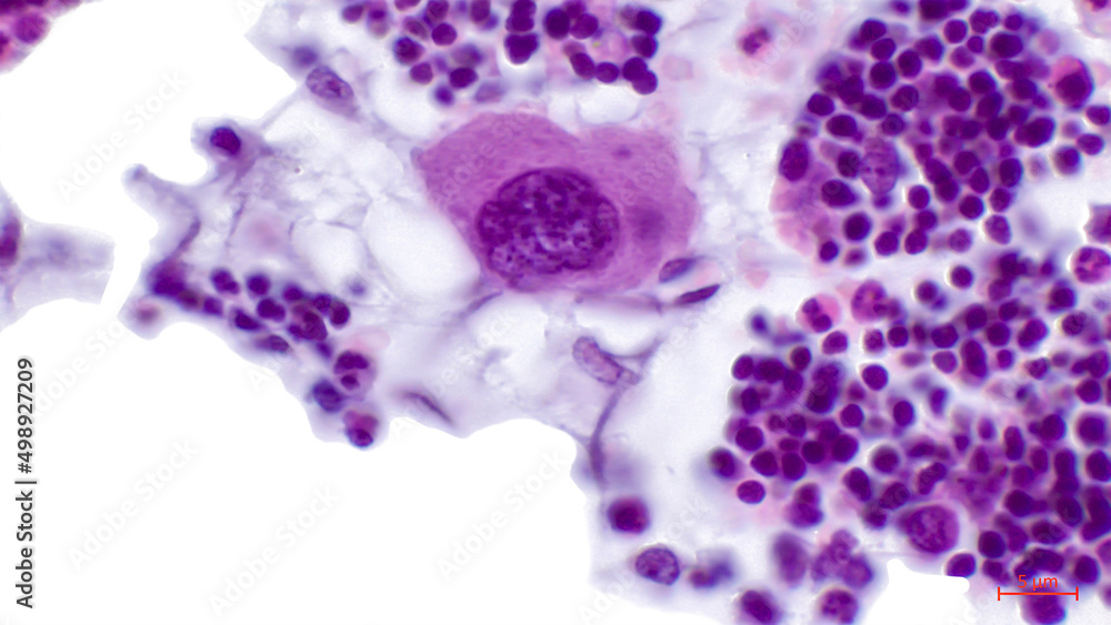 The largest cell in the red bone marrow is the megakaryocyte (located ...
