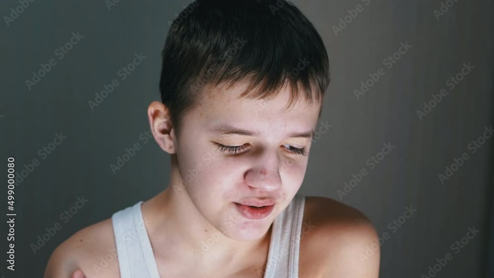 Portrait of a Smiling, Speaking Teenager with Acne on Face, Looking ...