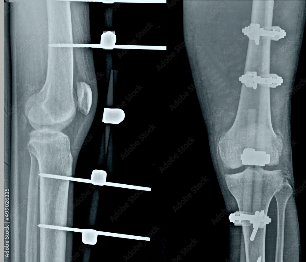 RADIOGRAFÍA CORRECCION FRACTURA DE TIBIA – Stock-Foto | Adobe Stock