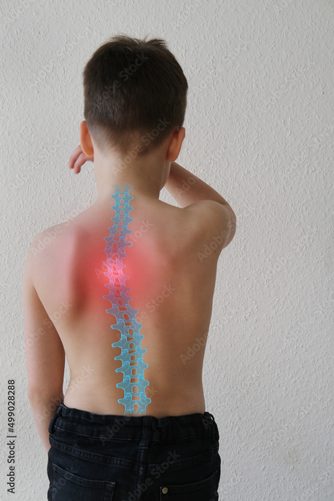 naked back of boy, child 8-10 years old, curved spine, red spot as ...