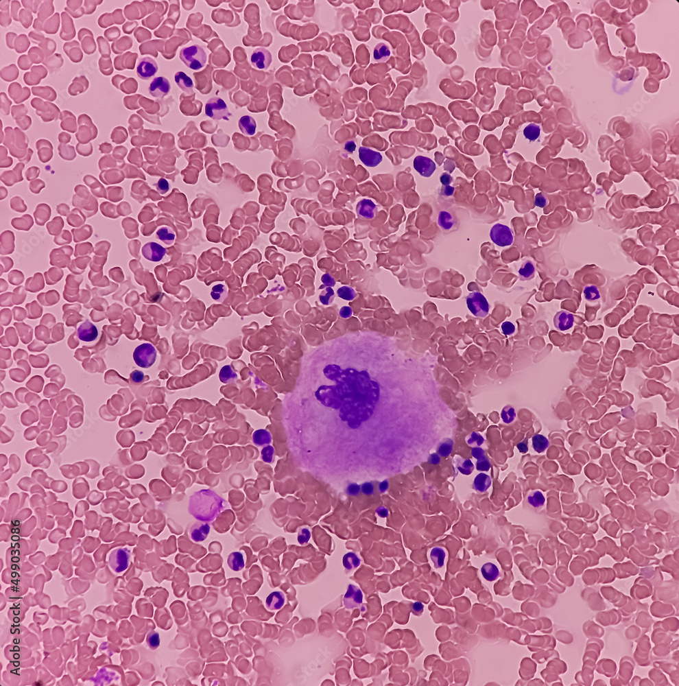 Bone marrow study: a megakaryocyte is a large bone marrow cell with a ...