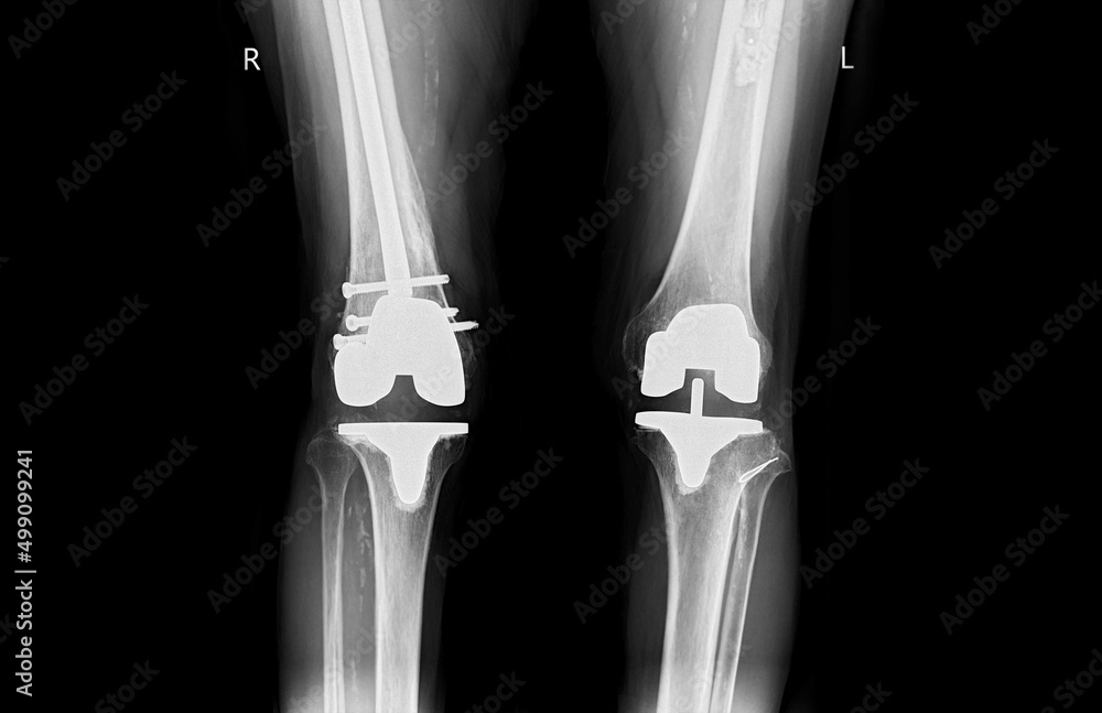 film x-ray knee AP view of osteoarthritis knee patient and artificial ...