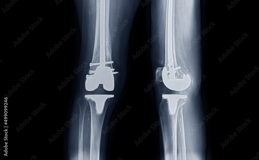 film x-ray Left knee AP and lateral view of osteoarthritis knee patient ...
