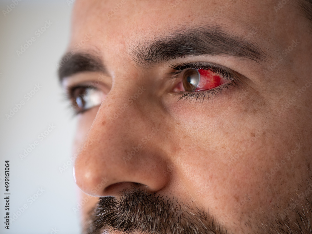 Subconjunctival hemorrhage on man eye. Bloody eye. Broken blood vessel ...