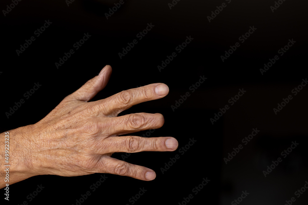 Elderly man's right hand with amputated middle finger on black ...