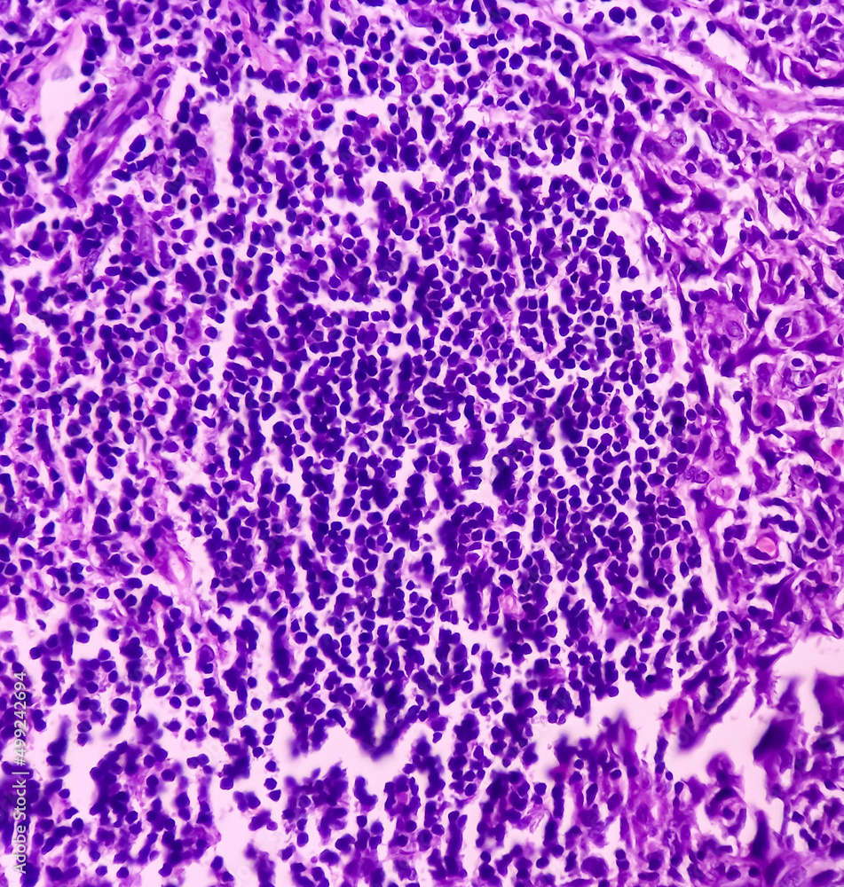 Tonsillar growth(biopsy): Tonsils cancer, Invasive squamous cell ...