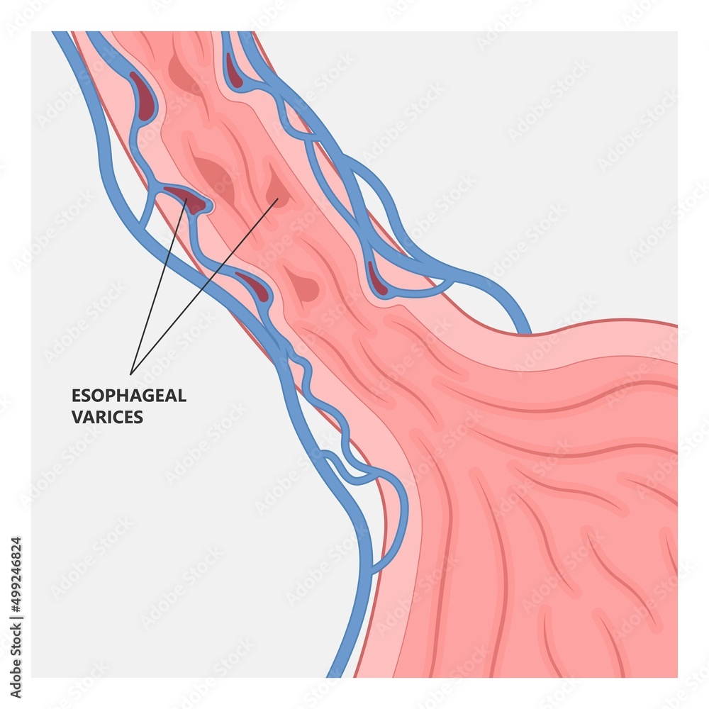 Oesophageal varicose swollen Nursing care Weiss tear upper gastric ...